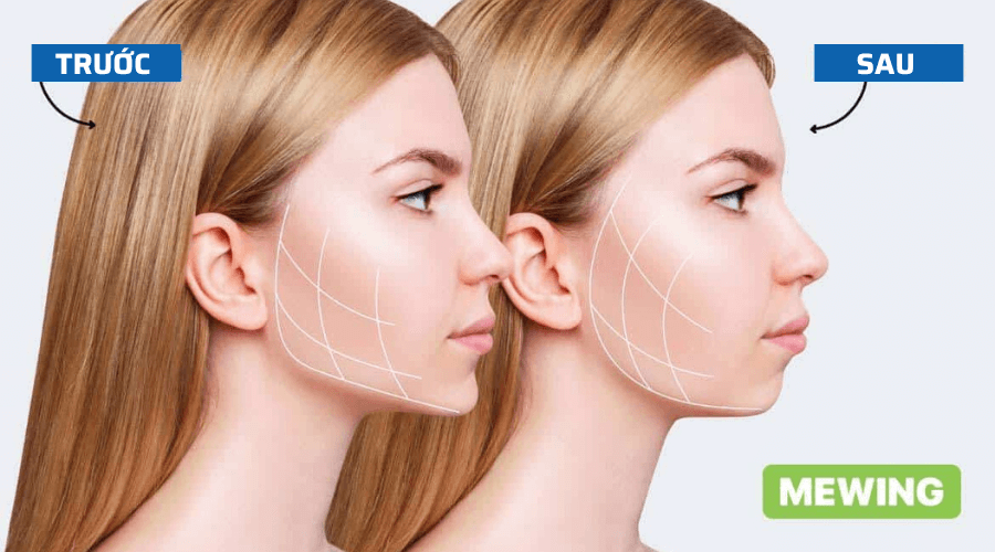 Mewing là gì? Các bài tập mewing đơn giản hiệu quả: Kim Dental